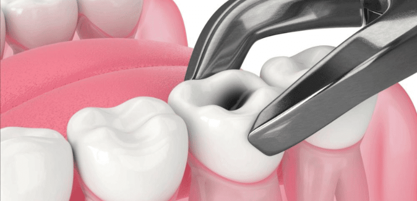 Wisdom Tooth Extraction Aftercare: Dos and Don’ts | Young Dental Health ...